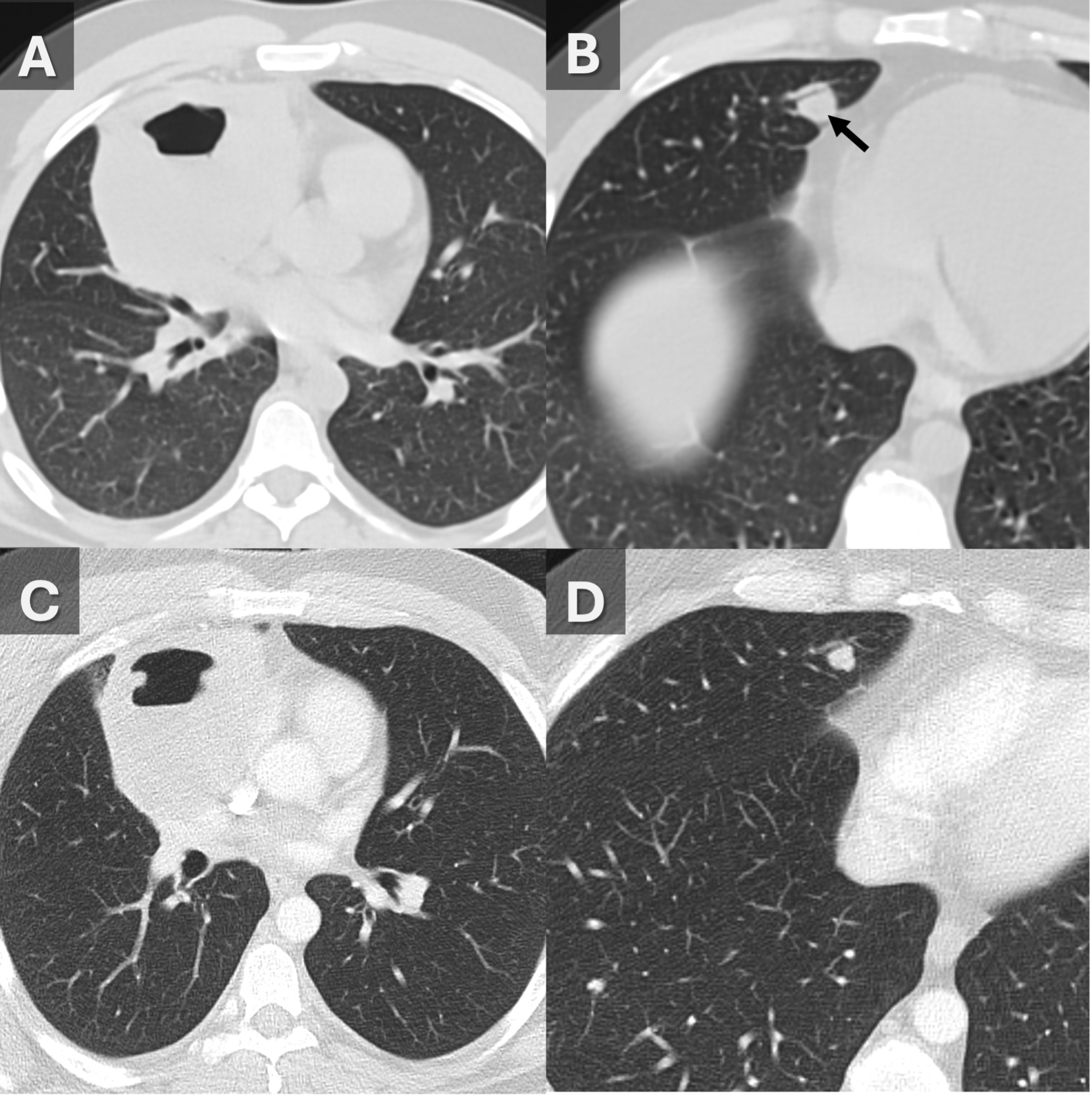 Cavitary Lung Lesion: An Unusual Presentation of Primary Mediastinal B ...